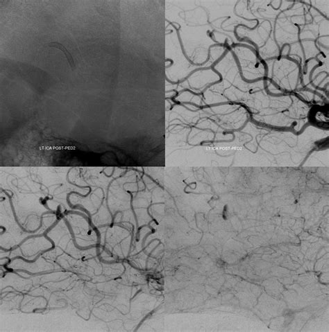 Balloon Test Occlusion