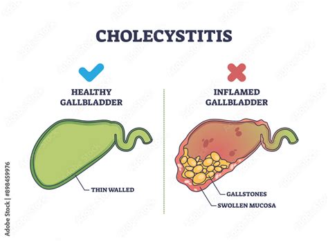 Cholecystitis As Inflamed Gallbladder Compared With Healthy Outline