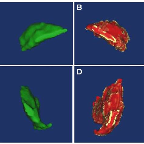 A The Typical Three Dimensional Mri Reconstruction Of Bilateral