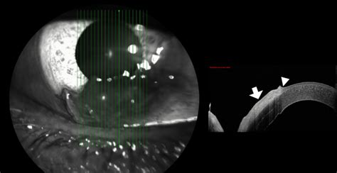 Pre Operative Anterior Segment Optic Coherence Tomography Download