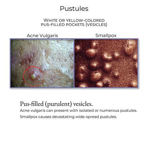 Clinical Pathology Glossary Pustule Ditki Medical And Biological Sciences
