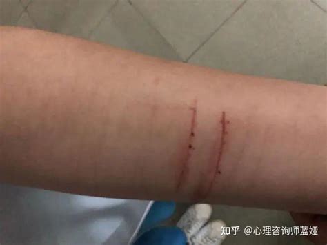 关注青少年心理健康 如何识别和应对儿童非自杀性自伤行为 知乎