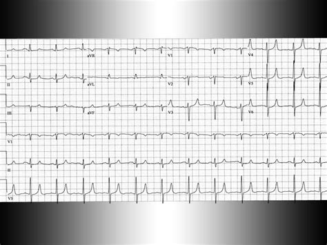 Nice Recommends New Therapy For Hyperkalaemia