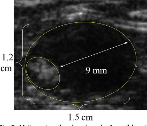 Figure 7 From Lymph Node Sonography Semantic Scholar