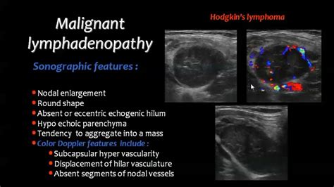 Lymphoma Thyroid Cancer Ultrasound Colors Something Serious Blogs
