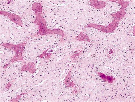 Osteosarcoma Histology