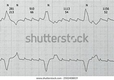 Atrial Flutter Electrocardiogram стоковая иллюстрация 2502408819 Shutterstock