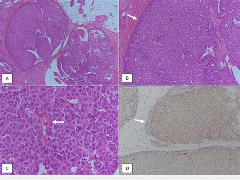 Solid Papillary Carcinoma In Situ A H And E Sections At 40x