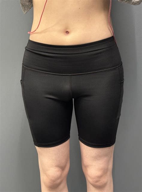 Female Custom Hip Implants Front 2 Dr Barry Eppley Explore Plastic