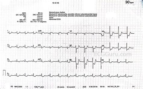 Severe Triple Vessel Disease Ecg Guru Instructor Resources