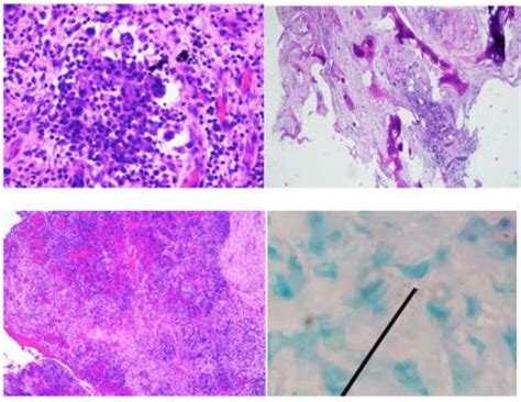 Figure 4 From Osteomyelitis Tuberculosis In Long Bone Mimicking Bone Malignancy A Case Report