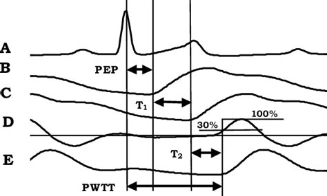 Figure 1 From A Novel Continuous Cardiac Output Monitor Based On Pulse Wave Transit Time