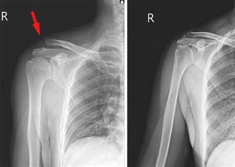 Ac Joint Repair Reconstruction Orthopedic Shoulder Doctor Sugar