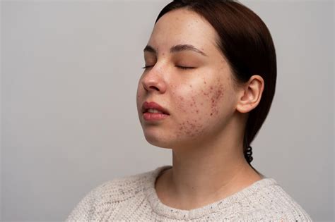 Causes Of Acne And How To Get Rid Of Acne Ipal Clinic