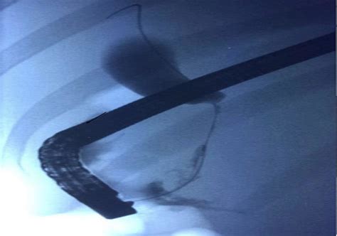 Cholangiogram Findings Stenosis In The Lower Third Of Common Bile Duct