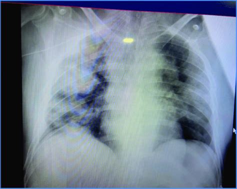 Chest Radiograph In Clinical Case Patient 3 Presenting Diffuse Download Scientific Diagram