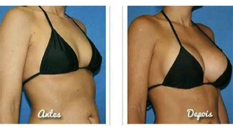 The Pros And Cons Of Breast Implants Artofit