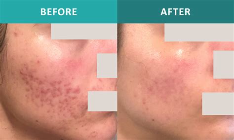 Dermatologist With Acne Patient