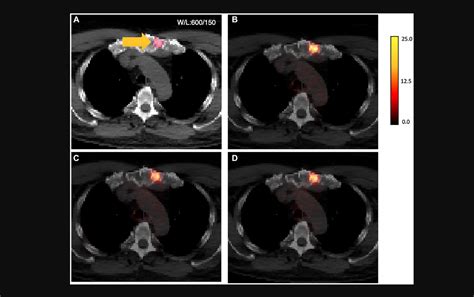 Deep Learning Based Whole Body Prostate Specific Membrane Antigen Pet