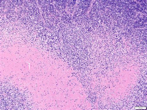 Kikuchi Disease Neuroradiology On The Net Scrofula