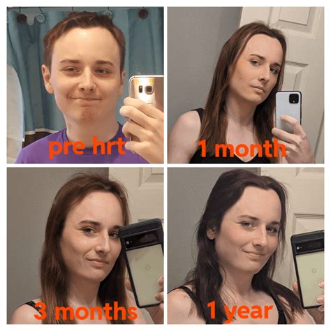 1 Year Hrt Timeline Of Just Face 25 Mtf R Transtimelines