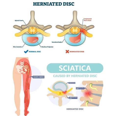 Herniated Disc Vs Sciatica Key Differences And Treatments