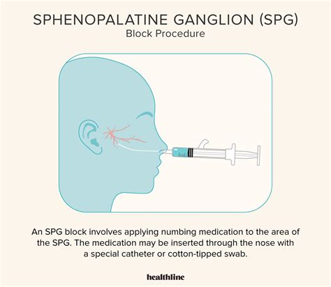 Sphenopalatine Ganglion Block
