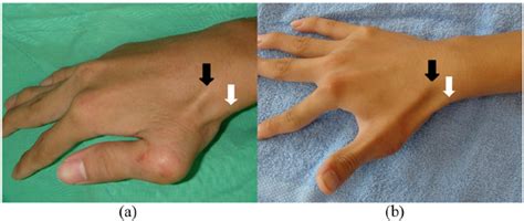 The Location Of Epl Epb Complex Is Shown Pre Operative Physical Download Scientific Diagram