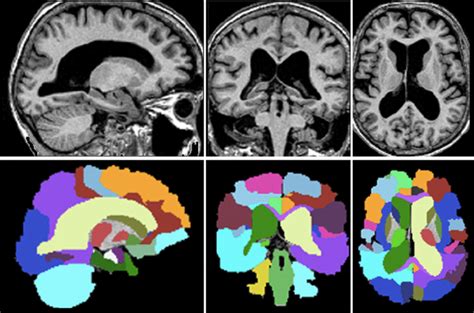 An Example Of The Propagation Of The Structural Parcellation To An Download Scientific Diagram