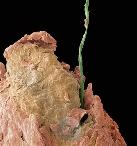 Tinea Pedis Microscope