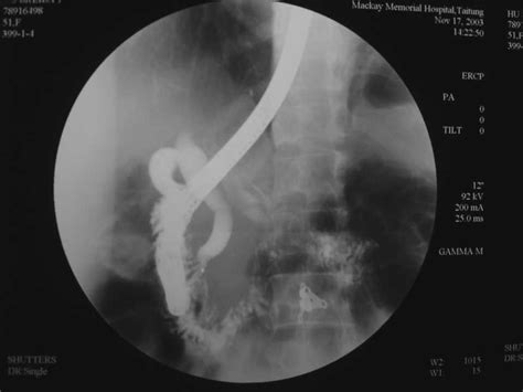 Endoscopic Retrograde Cholangiography With Injection Of Contrast Agent