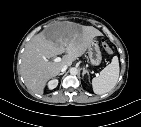 Amoebic Hepatic Abscess Radiology Reference Article