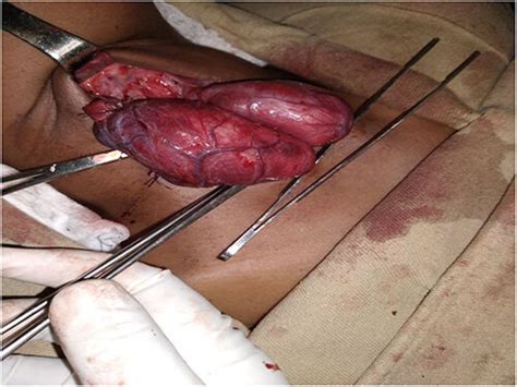 Bilateral Nodular Calcified Colloid Goiter Download Scientific Diagram