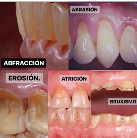 What Is The Difference Between Dental Attrition Abfraction Erosion