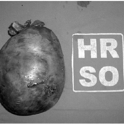 Bismuth Corlette Classification Three Patients With Type Iiia Three