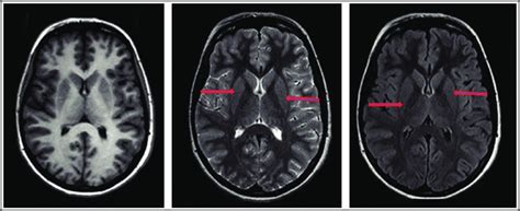 T1w T2w And Flair Magnetic Resonance Imaging Axial Images Suggestive