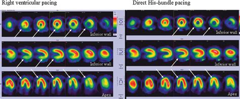 Example Of SPECT The Arrows Indicate The Perfusion Defects Mainly Download Scientific Diagram