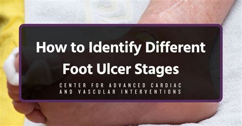 How To Identify 4 Different Foot Ulcer Stages