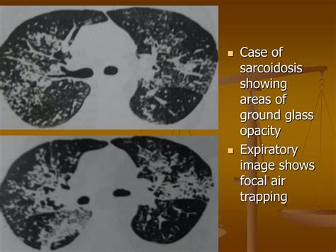 Sarcoidosis Radiology Pulmonary Neuro Abdominal Ppt