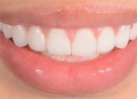 What Do Teeth Look Like Under Veneers See Real Life Images