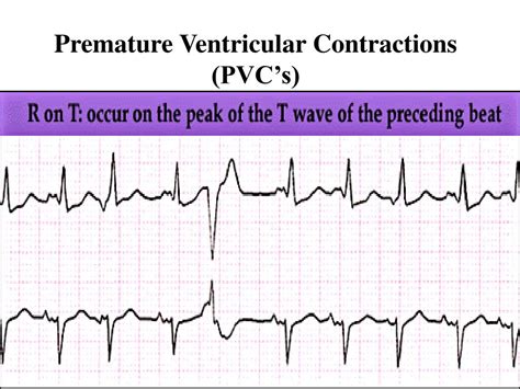 Ppt Prepared By Anwar Issa Rn Bsn Ccrt Icu Powerpoint Presentation