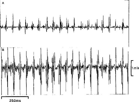 Primary Orthostatic Tremor Semantic Scholar