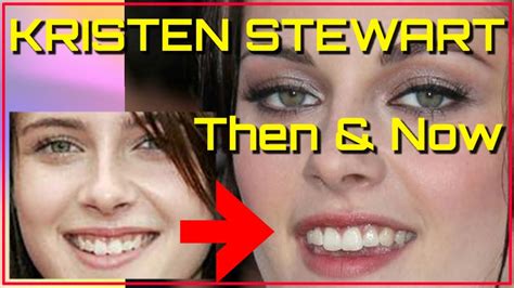 Kristen Stewart Teeth Before And After