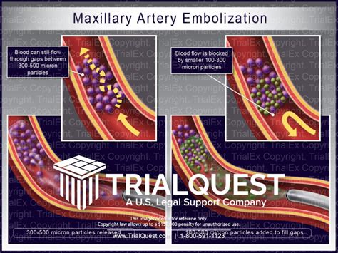 Maxillary Artery Embolization Trialquest Inc