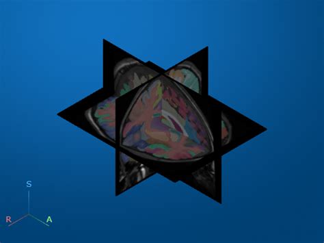 Segment And Analyze Brain Mri Scan Using Ai Matlab And Simulink