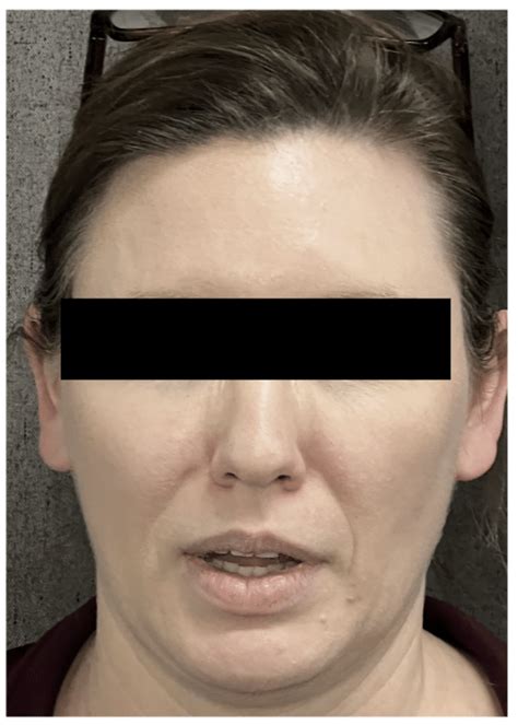 Botox Jallure Medispa