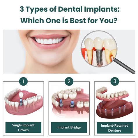 3 Types Of Dental Implants Which One Is Best For You Riverside Oral