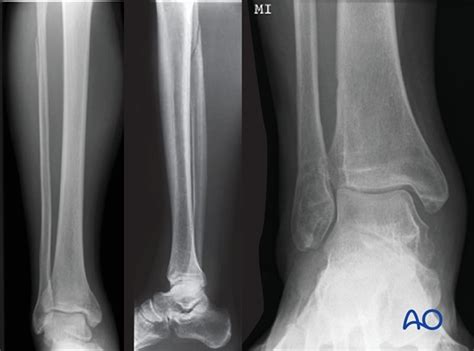 Distal Tibiofibular Joint X Ray