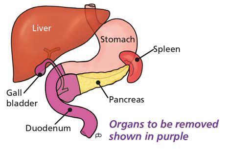 Whipples Operation Pylorus Preserving Pancreatico Duodenectomy Leeds Teaching Hospitals Nhs