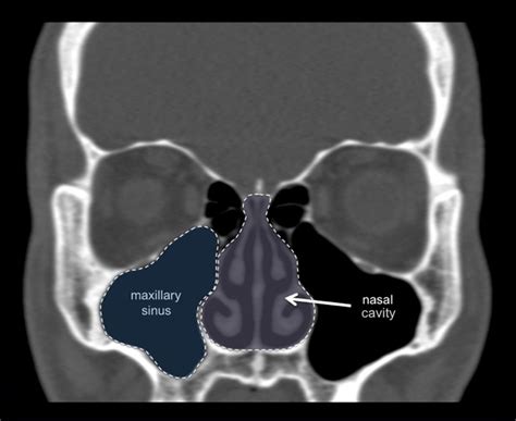 Maxillary Sinus Anatomy